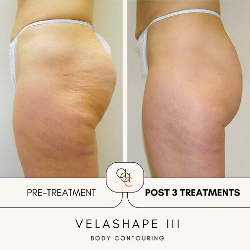 VelaShape III | Anti Aging Centers